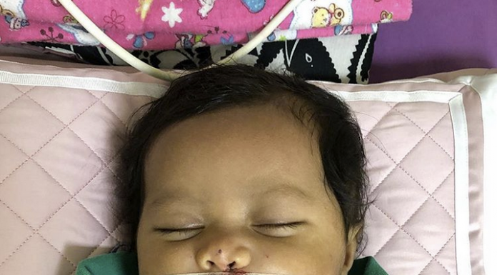 Alhamdulillah Pembedahan Sumbing Baby Xandra Dah Selesai, Ini Doa Lan ...