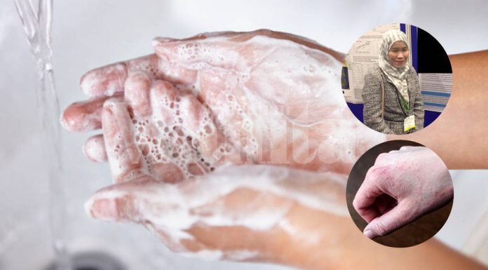 Kerap Basuh Tangan Lagi Teruk, Hand Dermatitis Jari Kering, Gatal-Gatal ...